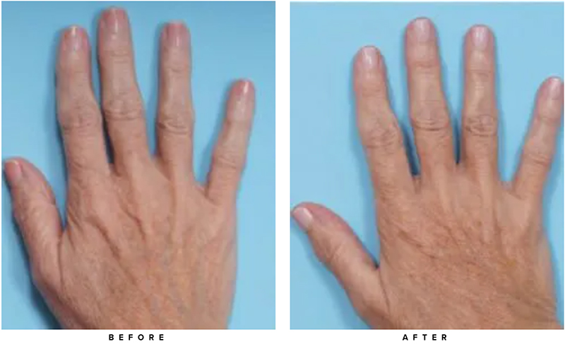 Non-Surgical Hand Rejuvenation | Balikian Plastic Surgery