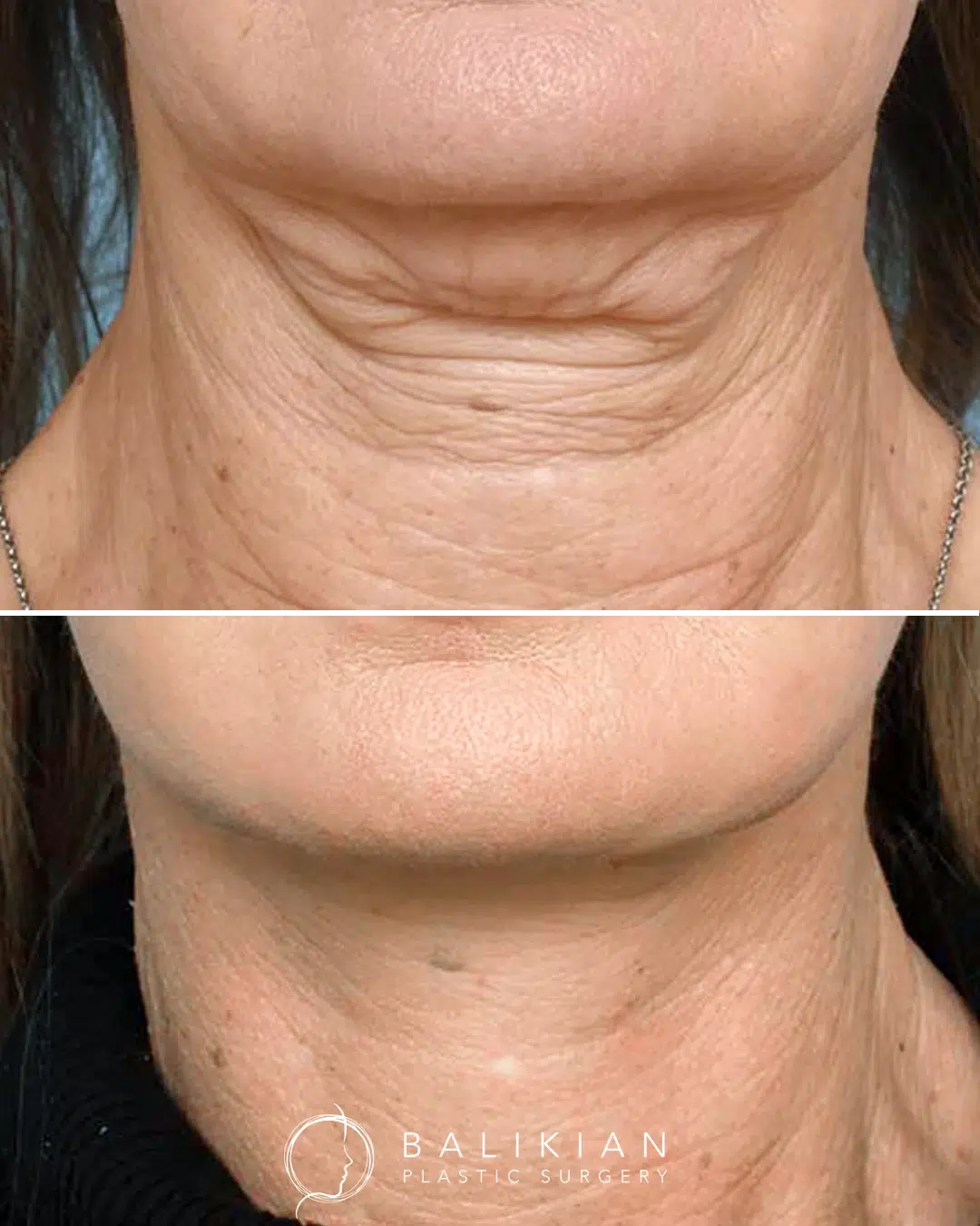 Fractionated CO₂ Laser Resurfacing | Real Patient Results