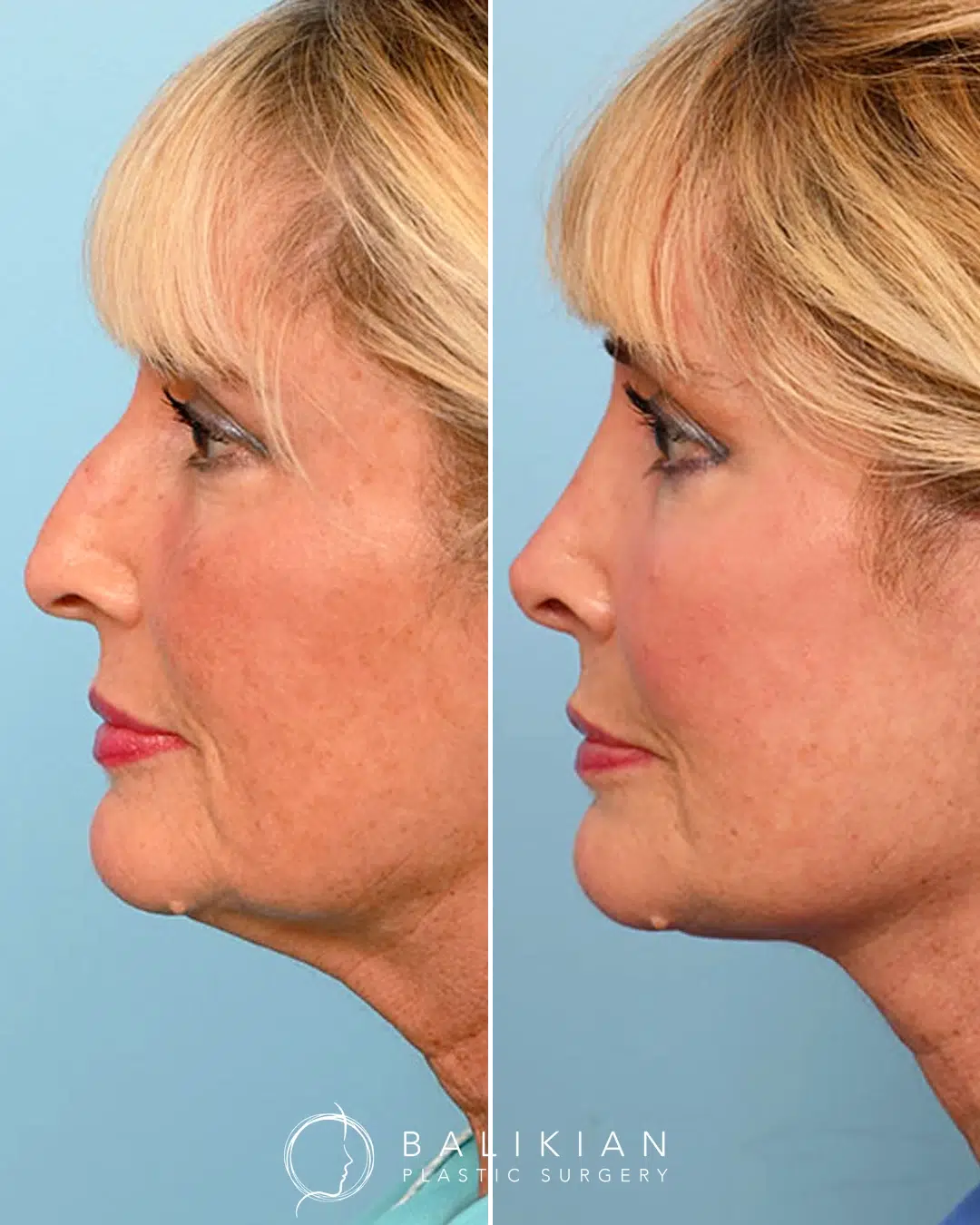 Fractionated CO₂ Laser Resurfacing | Real Patient Results