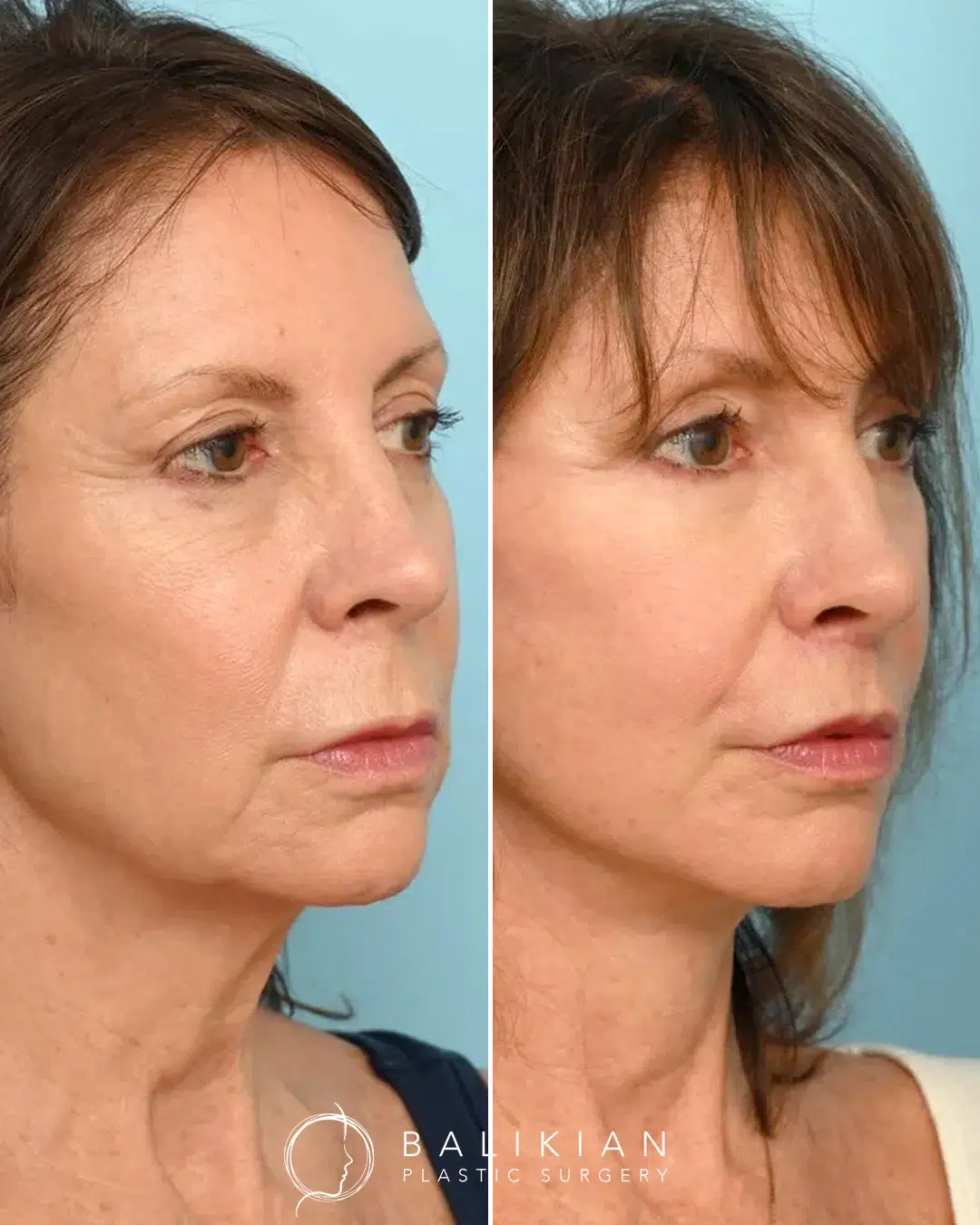 Fractionated CO₂ Laser Resurfacing | Real Patient Results