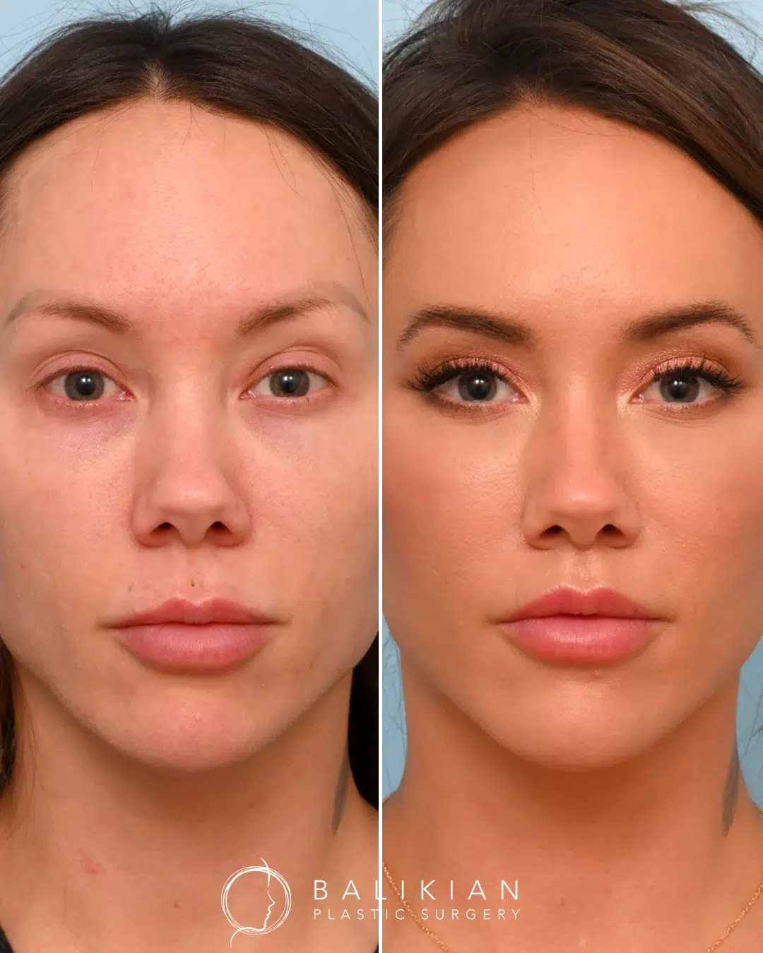 Before & After Subnasal Lip Lift Patient Transformations