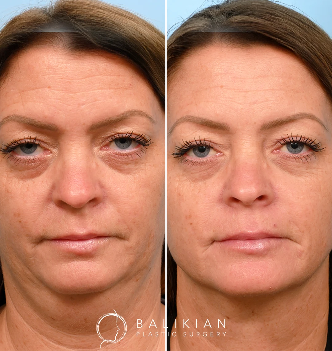 Neck Liposuction Before and After Patient Transformations