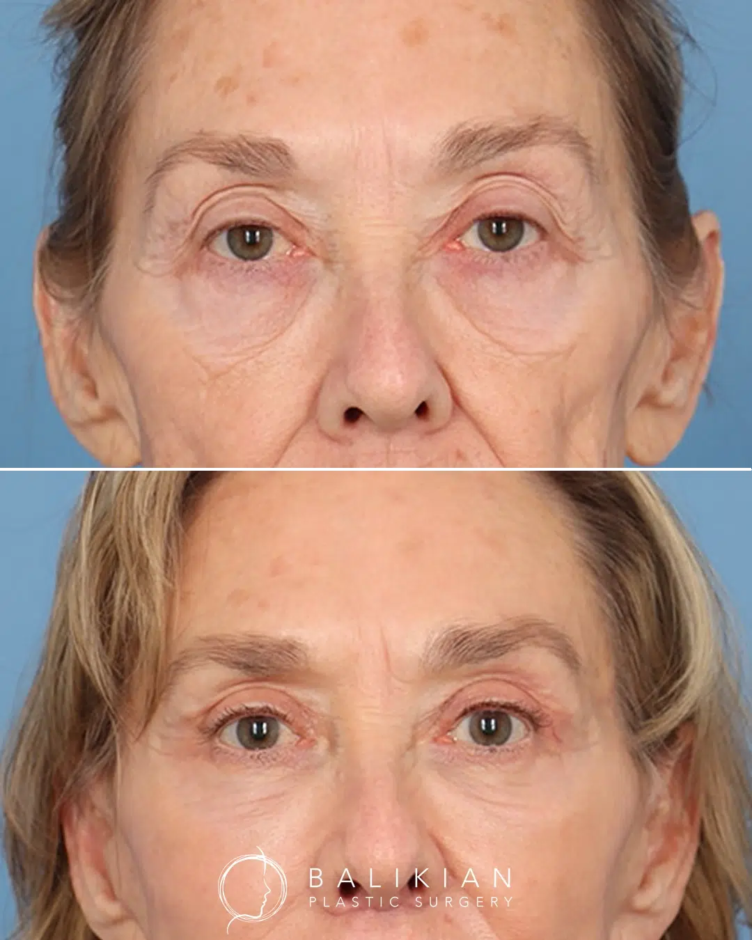 Upper and Lower Eyelid Surgery Patient Transformations