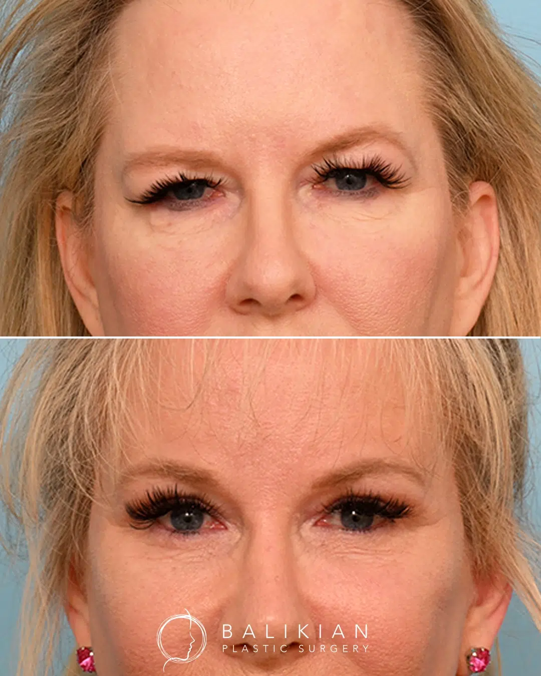Upper and Lower Eyelid Surgery Patient Transformations