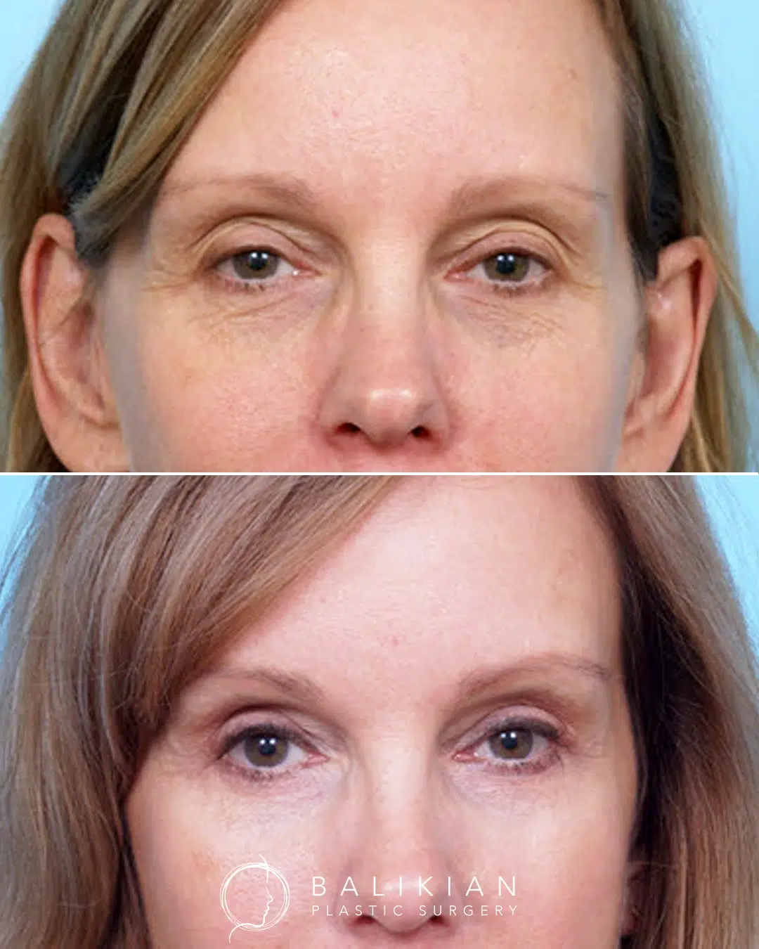 Upper and Lower Eyelid Surgery Patient Transformations