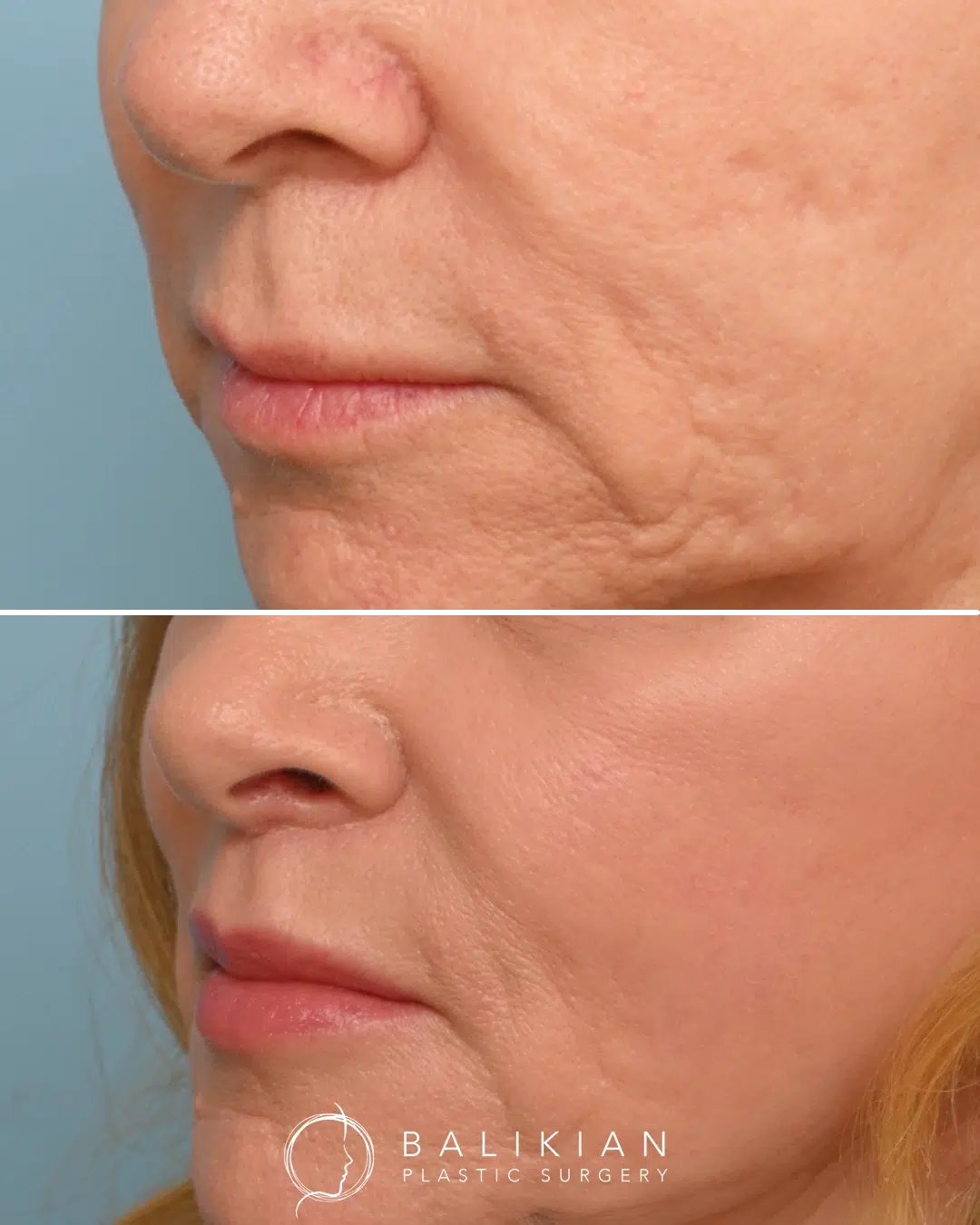 Before & After Subnasal Lip Lift Patient Transformations