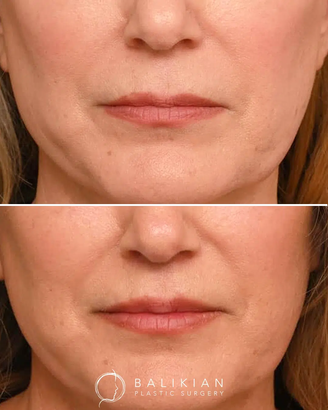 Before & After Subnasal Lip Lift Patient Transformations