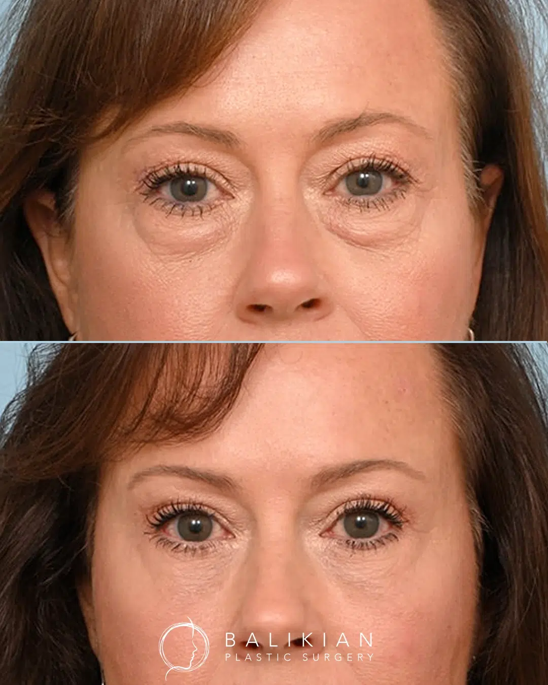 Upper and Lower Eyelid Surgery Patient Transformations